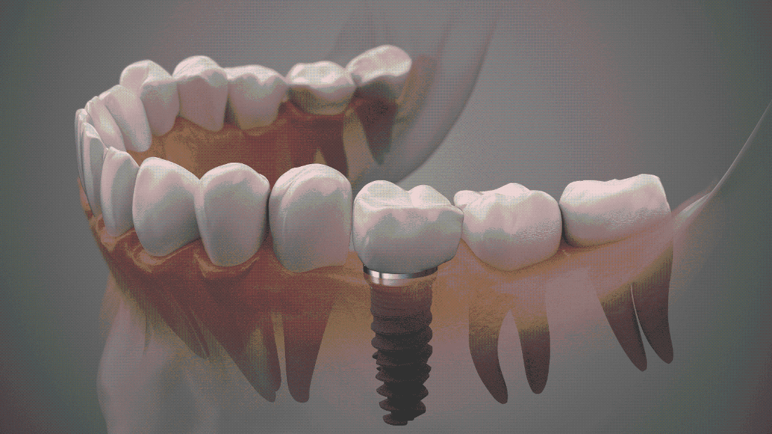 The Importance of Replacing Missing Teeth | Dental Implants Armidale NSW